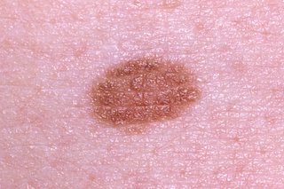 Moles: benign and cancerous types - HSE.ie