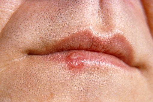 Cold sores - HSE.ie