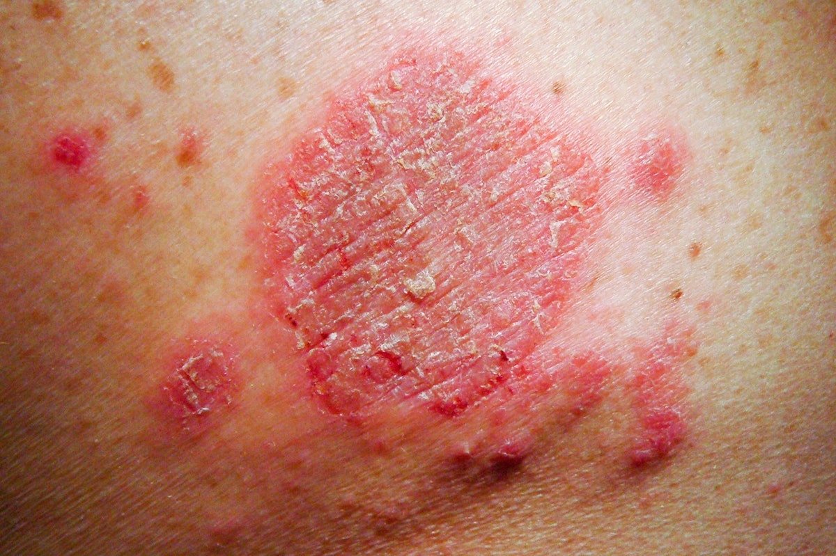 Eczema - Symptoms and diagnosis - HSE.ie