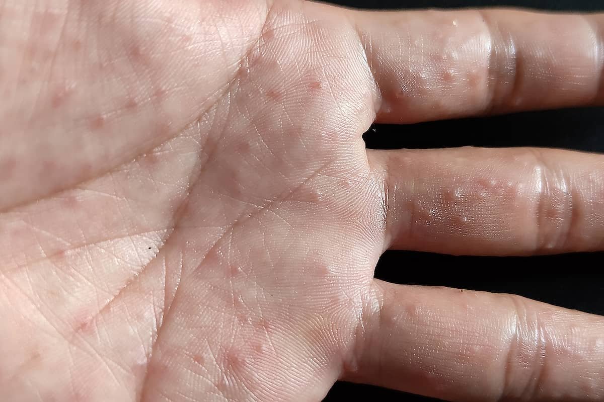Eczema - Symptoms and diagnosis - HSE.ie