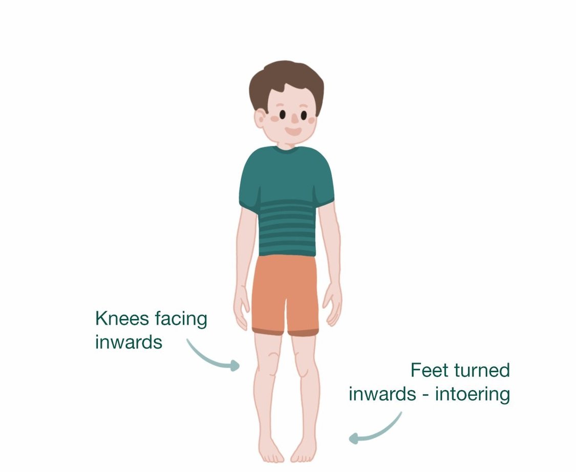 In-toeing and out-toeing - HSE.ie