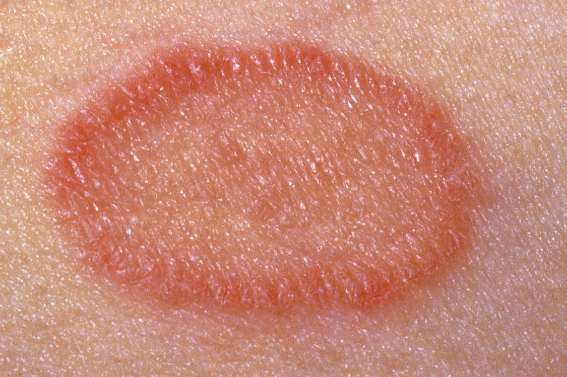Pityriasis rosea - HSE.ie