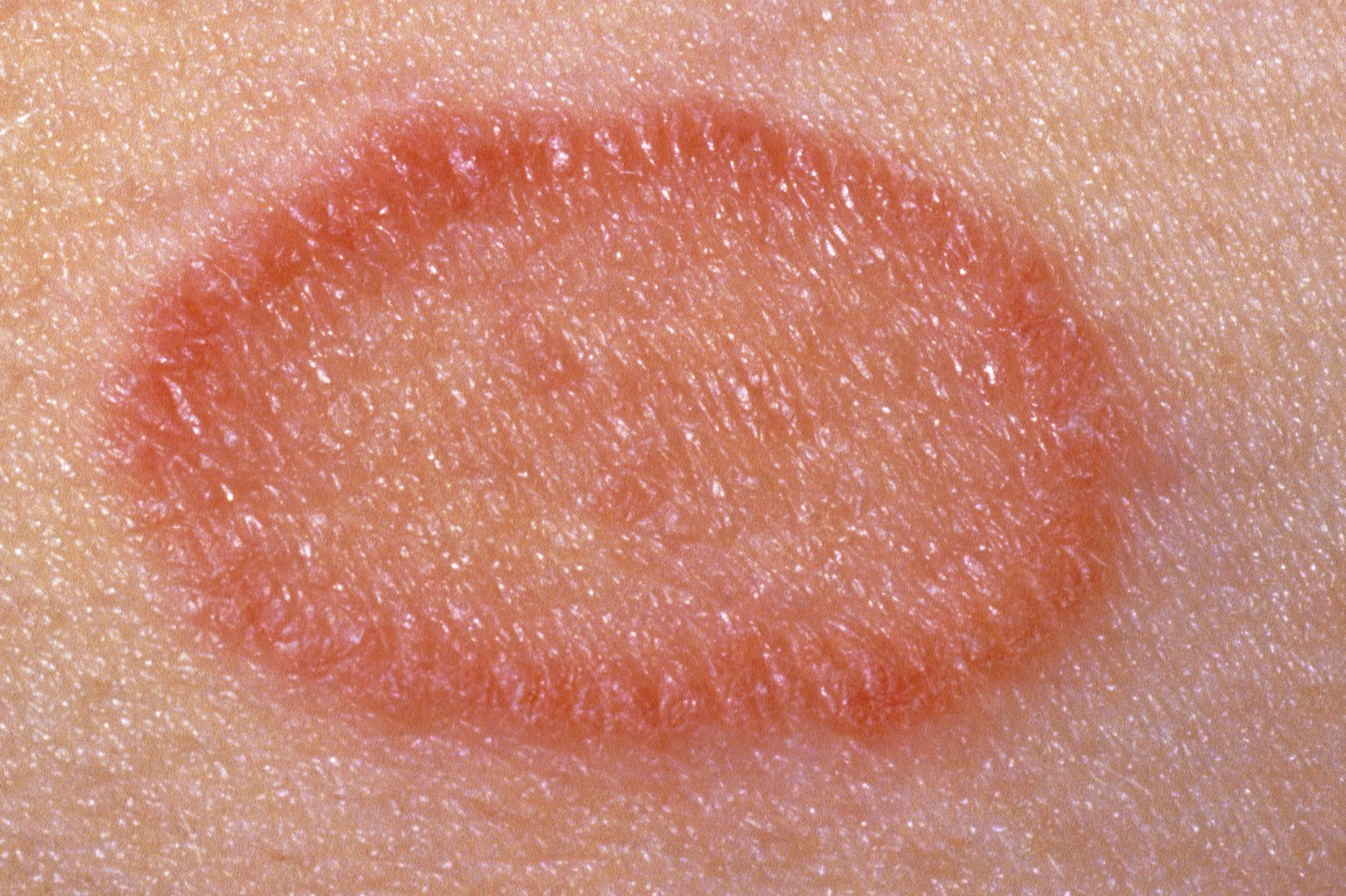 Pityriasis rosea: symptoms, causes, diagnosis and treatments - HSE.ie