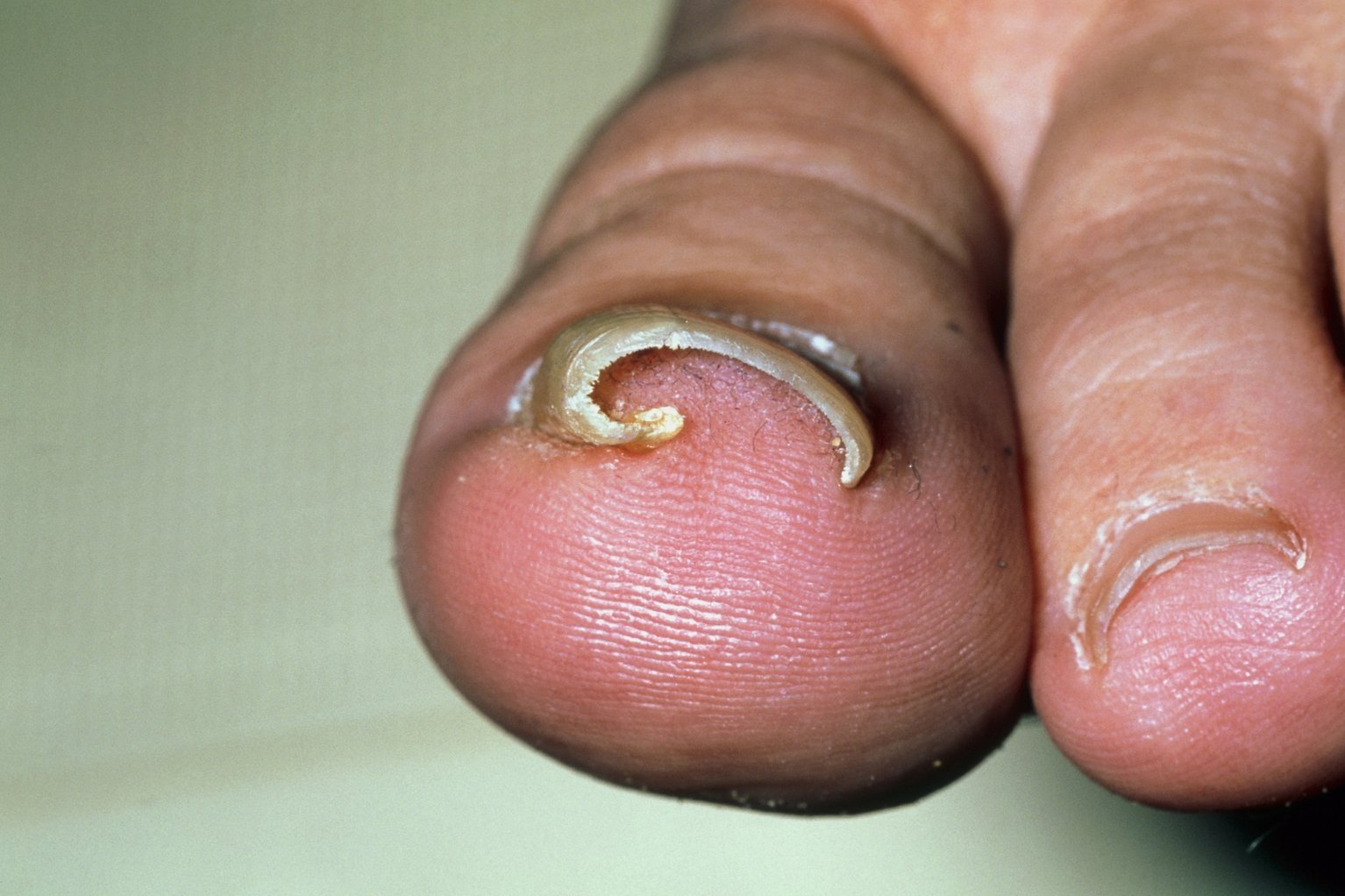 Ingrown toenail - HSE.ie