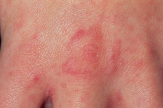 Scabies - HSE.ie