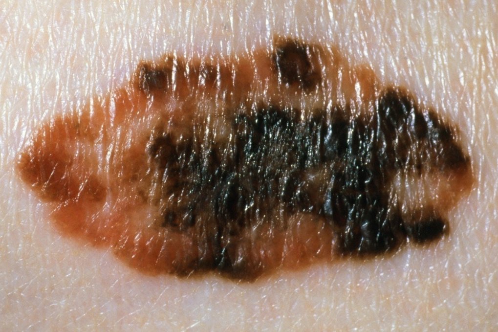 Moles: benign and cancerous types - HSE.ie