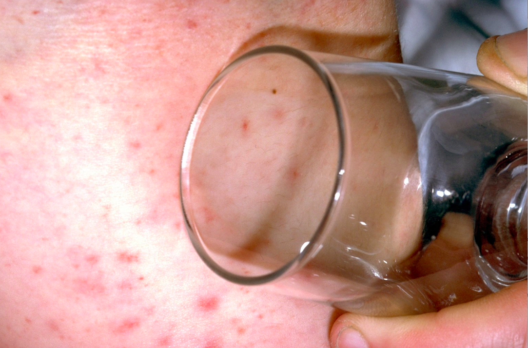 Meningitis and septicaemia - symptoms