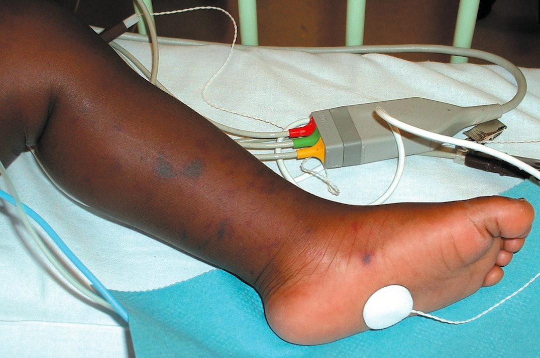 Meningitis and septicaemia - symptoms - HSE.ie