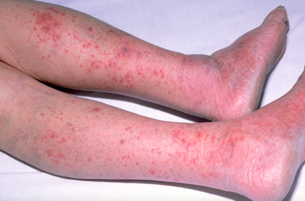 Meningitis and septicaemia - symptoms