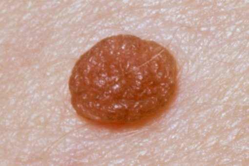 Moles - HSE.ie