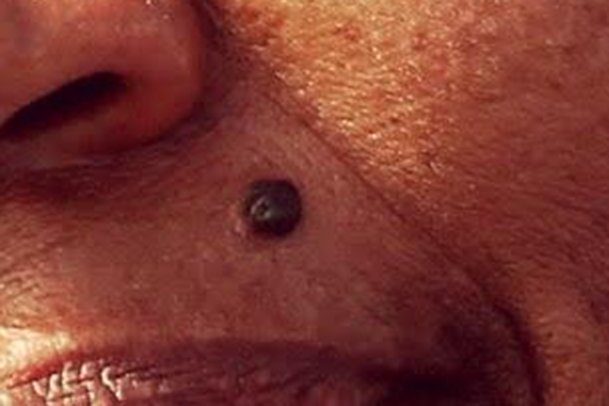 Moles: benign and cancerous types - HSE.ie