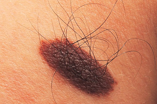Moles: benign and cancerous types - HSE.ie