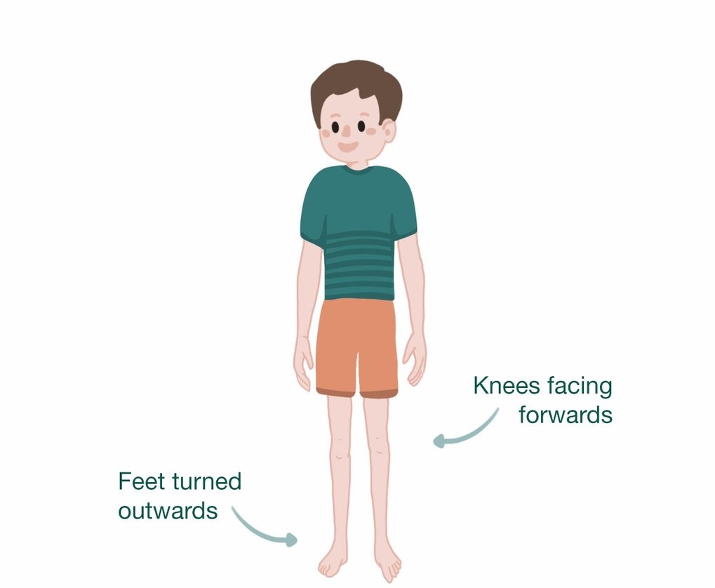 In-toeing and out-toeing - HSE.ie