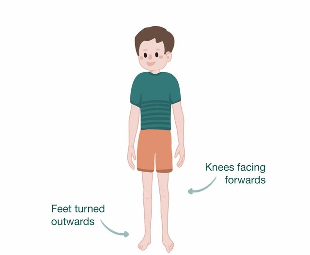 In-toeing and out-toeing - HSE.ie