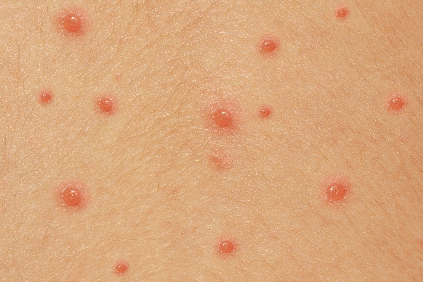Chickenpox - HSE.ie