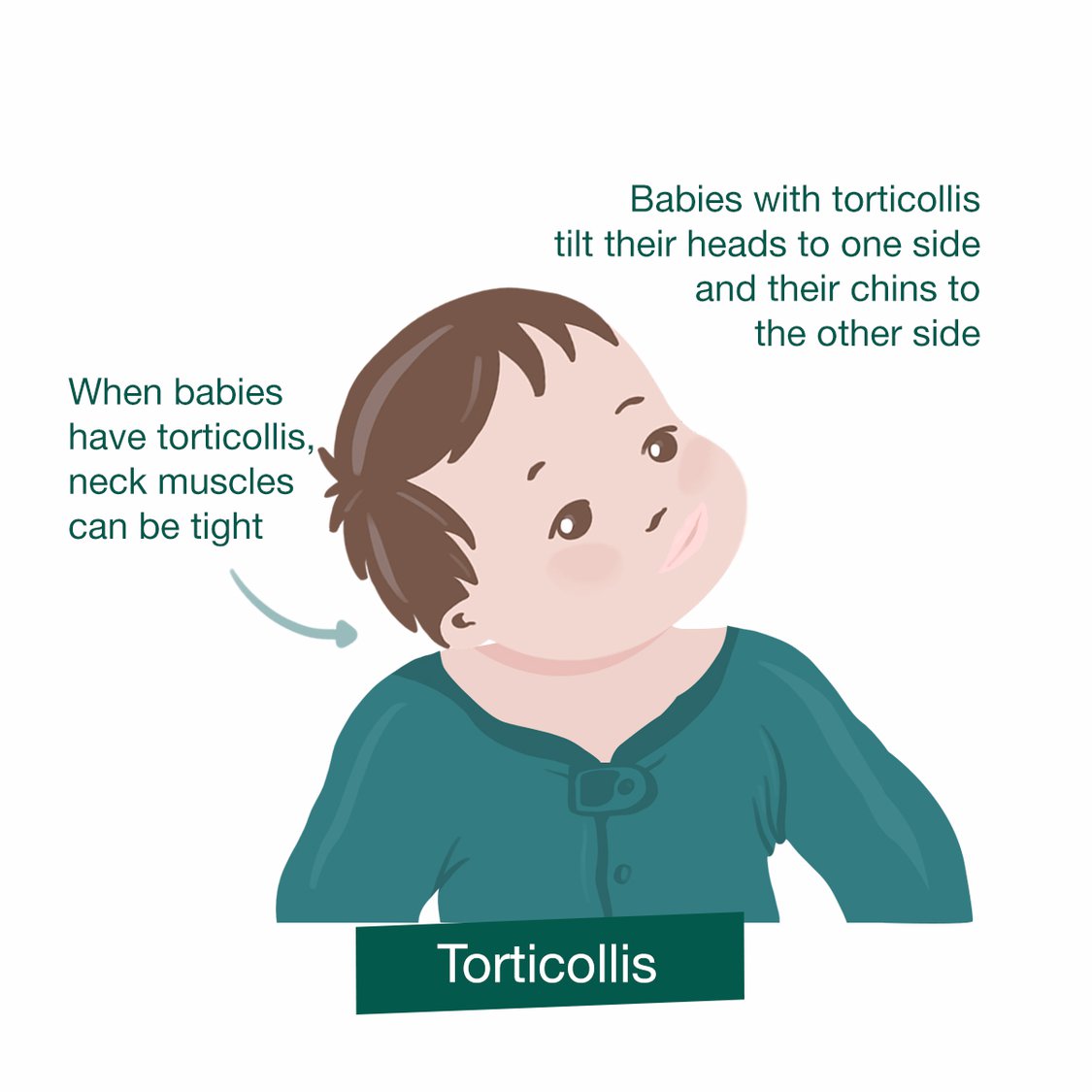 Torticollis in babies - HSE.ie