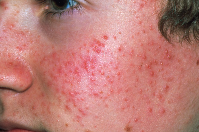 Acne symptoms and diagnosis - HSE.ie