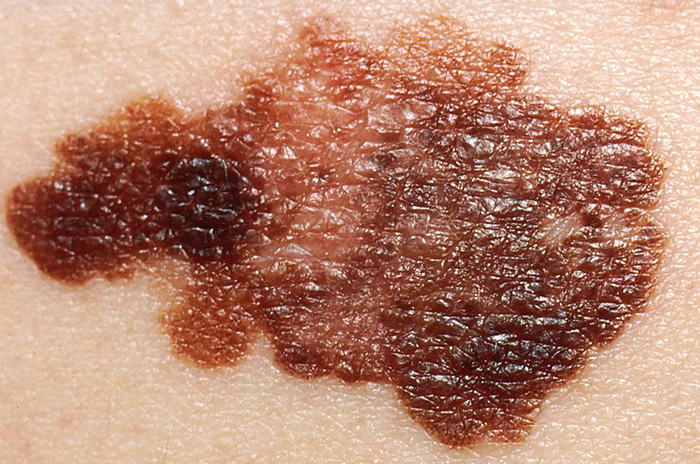 Skin cancer (melanoma) - Symptoms - HSE.ie