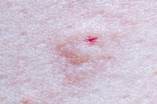 Insect bites and stings - Symptoms - HSE.ie