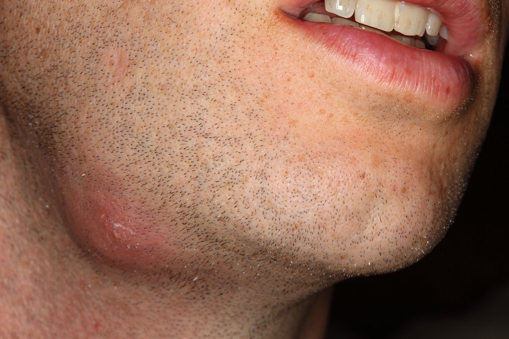 Staph infection: symptoms, causes, diagnosis and treatments