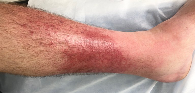 Cellulitis: signs, symptoms, causes and treatments