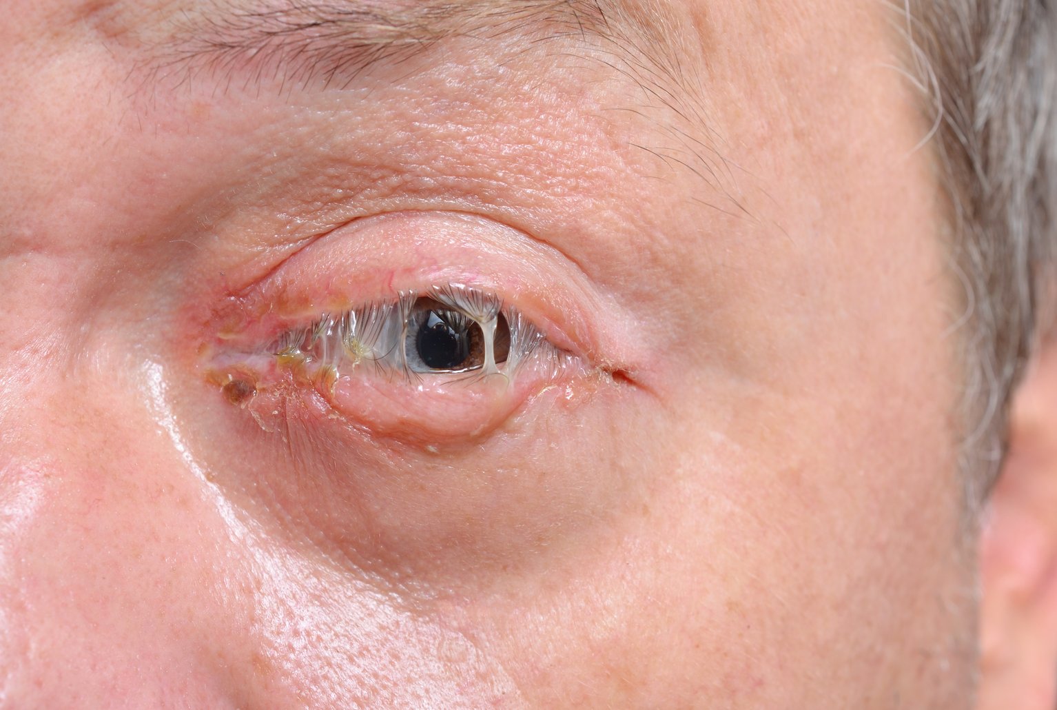 Conjunctivitis: signs, symptoms, causes and treatments
