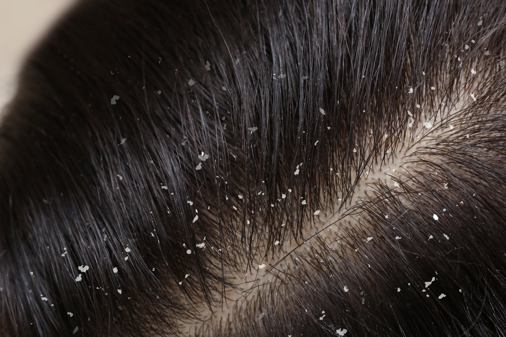 Dandruff: symptoms, causes and treatments