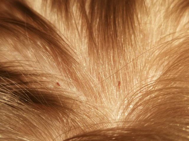 Head lice and nits: causes, symptoms and treatments