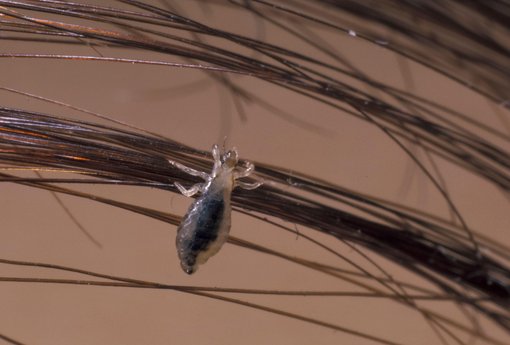 Head lice and nits: causes, symptoms and treatments