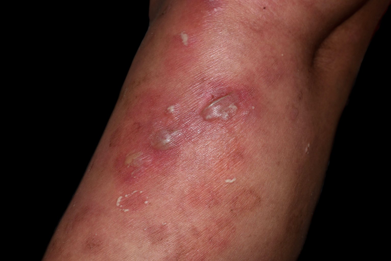 Impetigo: symptoms, causes, prevention and treatments