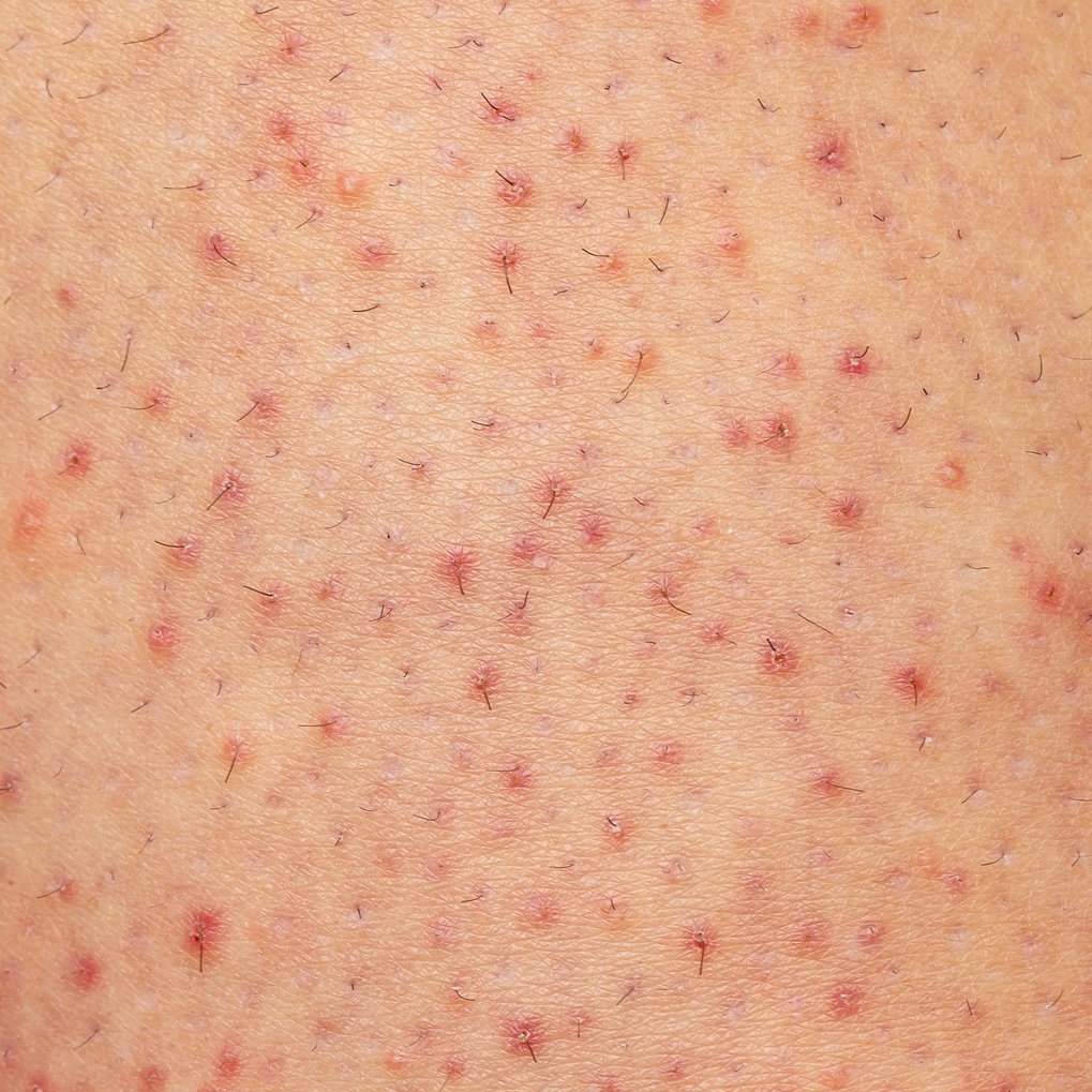 Ingrown hairs: symptoms, causes, prevention and treatments