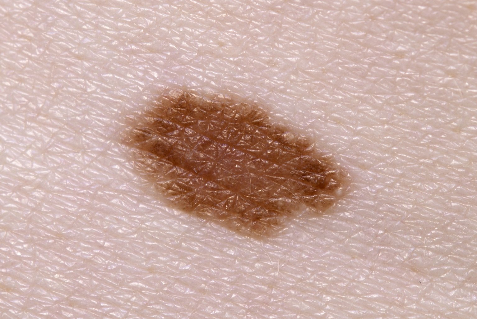 Moles: benign and cancerous types