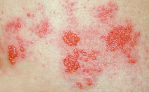 Shingles: symptoms, causes, diagnosis and treatments