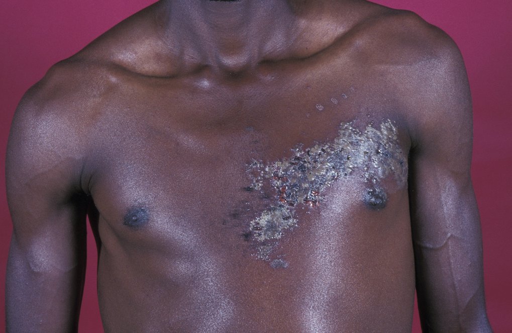 Shingles: symptoms, causes, diagnosis and treatments