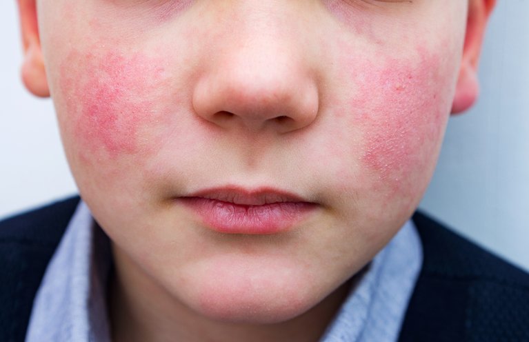 Parvovirus (slapped cheek disease) and pregnancy: symptoms, causes ...