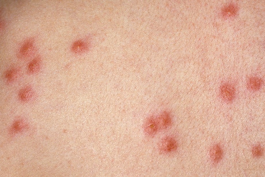 Insect bites and stings - Symptoms - HSE.ie