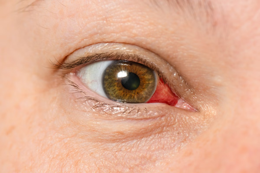 Red eye: symptoms, causes and treatments