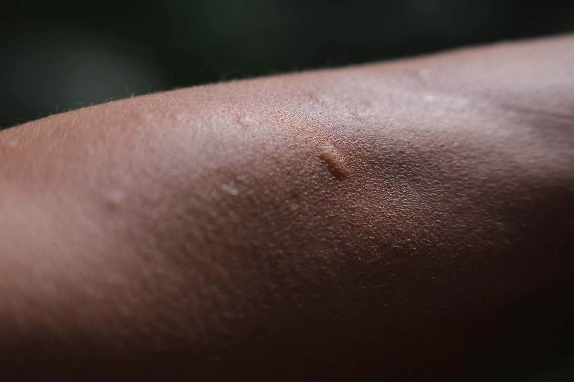 Insect bites and stings - Symptoms - HSE.ie