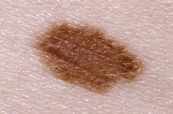 Skin cancer (melanoma) symptoms - HSE.ie