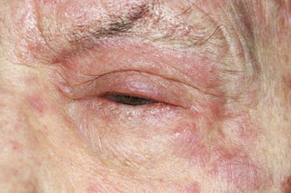 Shingles signs, symptoms, causes and treatments - HSE.ie