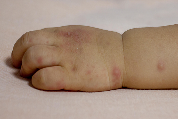 Hand, foot and mouth disease - HSE.ie