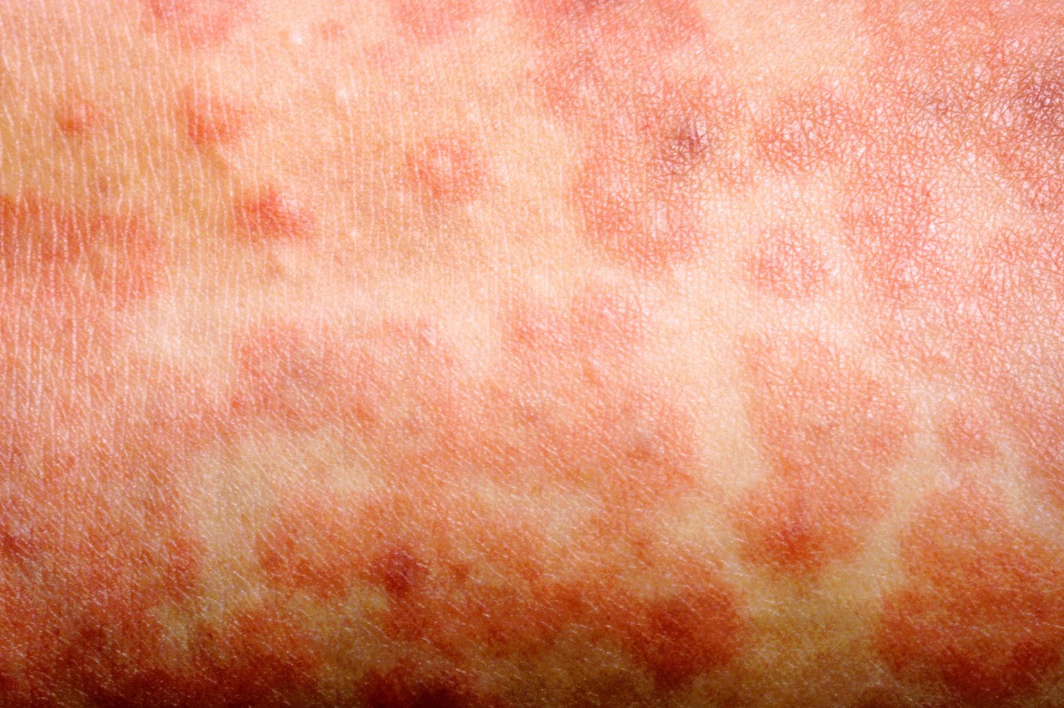 Measles - HSE.ie