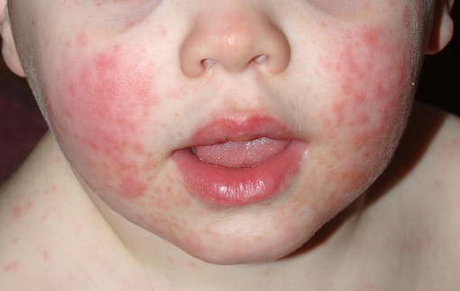 Slapped cheek syndrome: symptoms, causes, diagnosis and treatments - HSE.ie