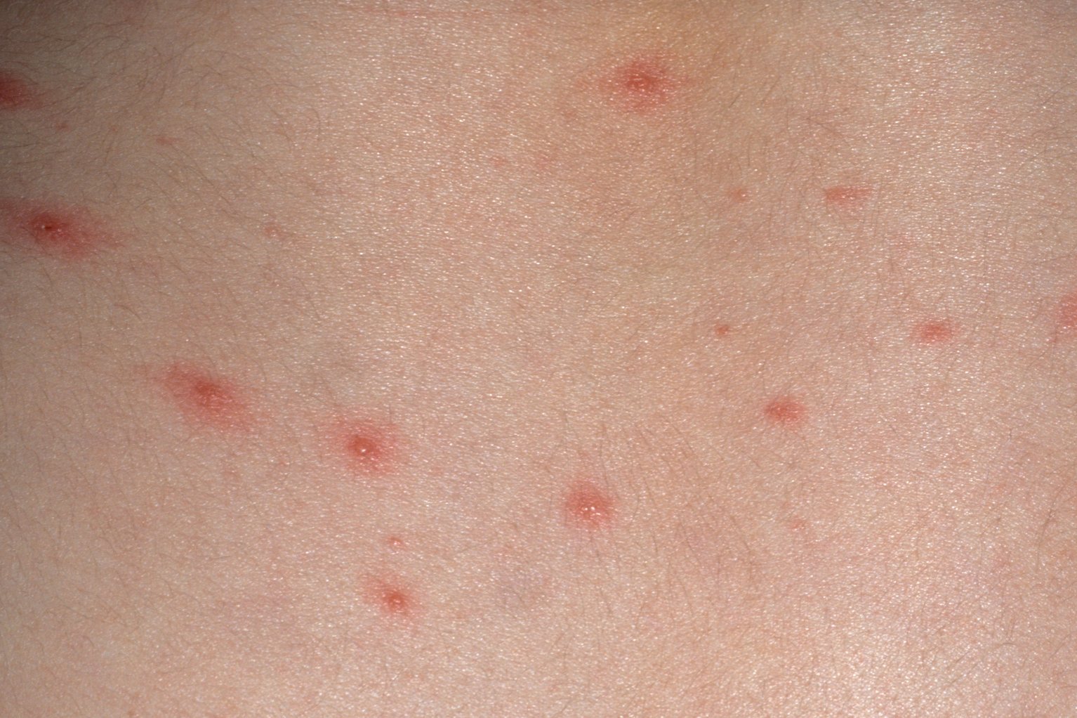 Chickenpox - HSE.ie