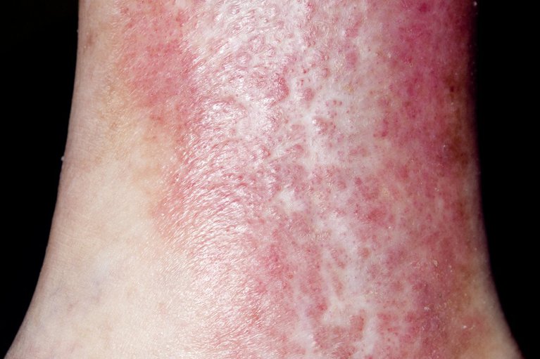 Eczema - Symptoms and diagnosis - HSE.ie