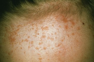 Warts and verrucas: types, causes, prevention and treatments - HSE.ie